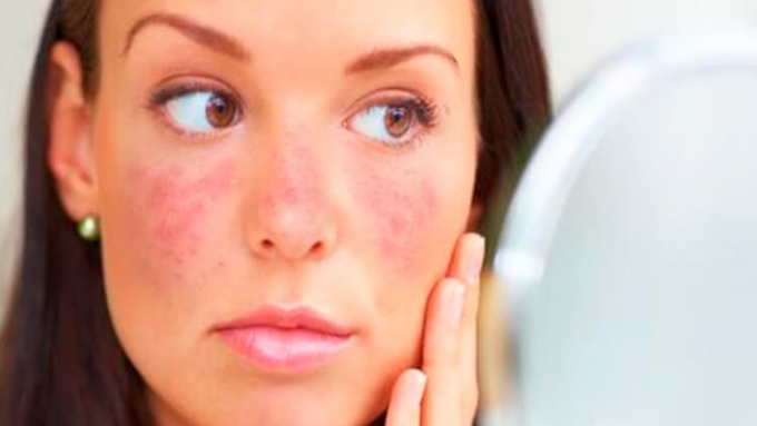 Lupus: Quinze (15) symptômes et signaux d'alarme à ne jamais ignorer ...